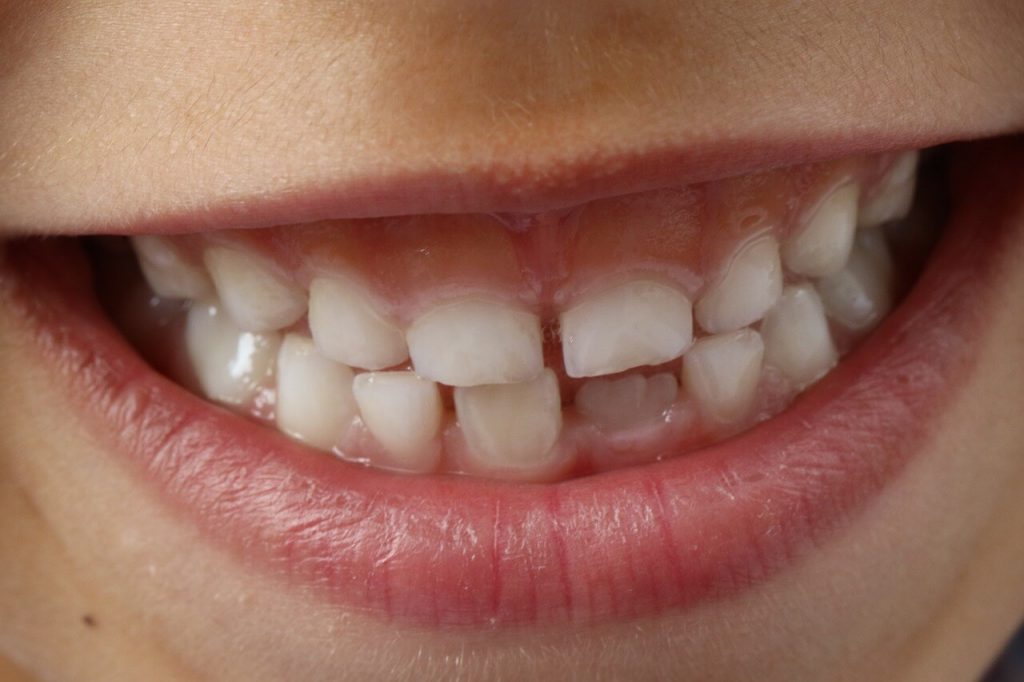 food stuck in teeth - VNF Nutrition